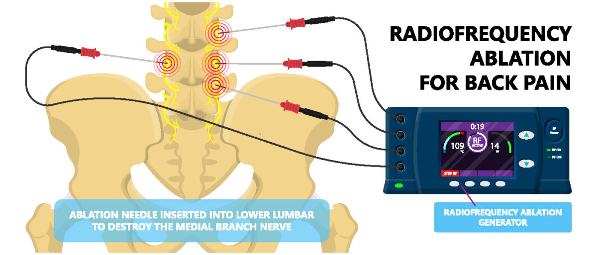 Radiofrequency Ablation